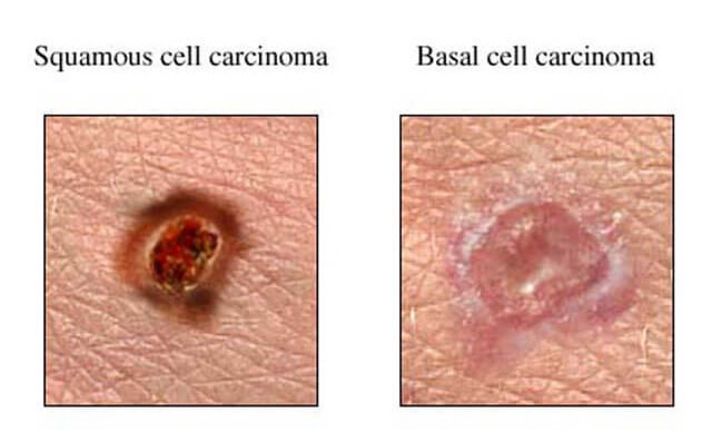 Squamous Cell Cancer Park Avenue Dermatology Dermatologist In